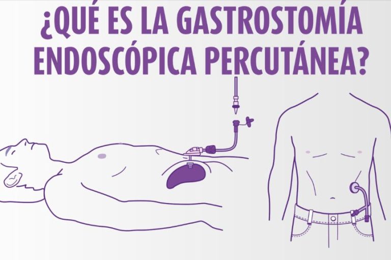 El botón gástrico y la gastrostomía endoscópica percuntánea